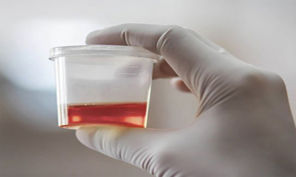 Urinary Bleeding – Best Urology Surgeon In Bhubaneswar | Dr.Debadarshi Rath